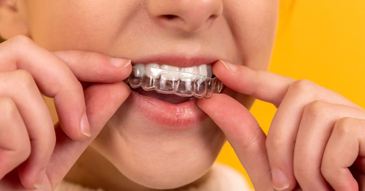Clear Aligners for the General Dentist - Dental Society of Western PA